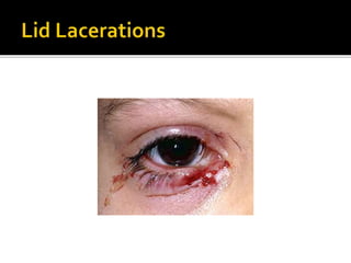 Pediatrics ocular trauma and emergencies | PPTX