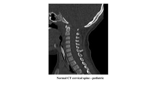 Pediatric spine injuries by Momen | PPTX