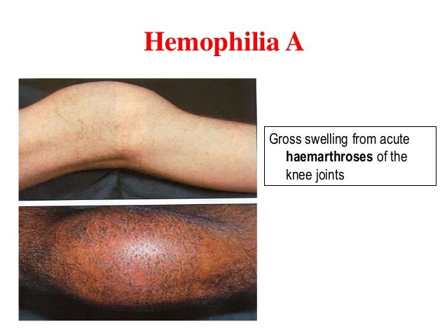 Aproach to bleeding disorder in Pediatrics