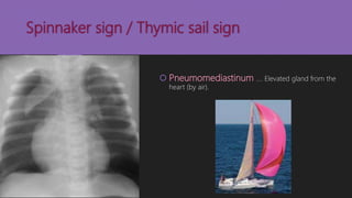 Pediatrics signs | PPT