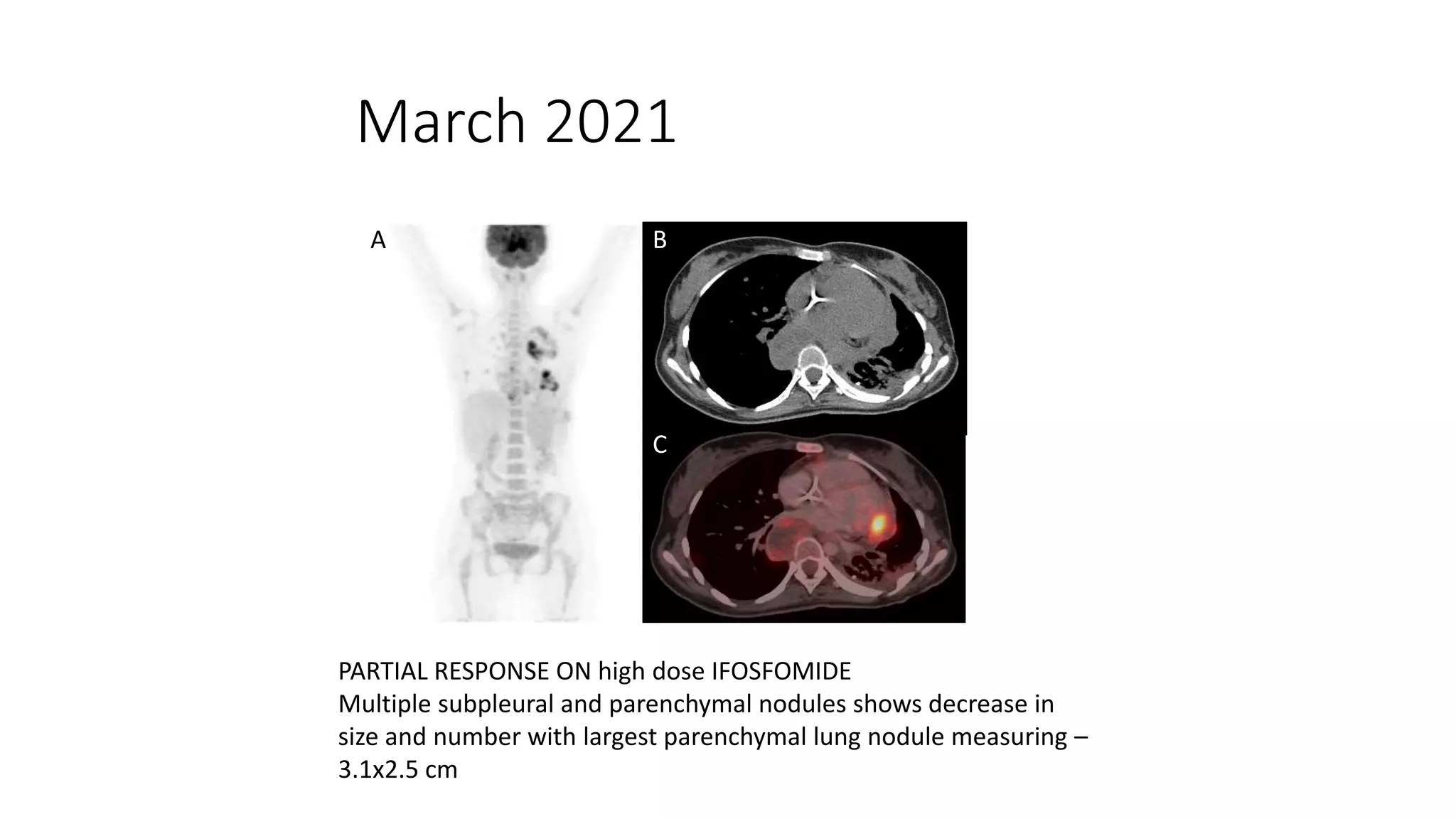 pediatric soft tissue sarcoma _ targeted therapy.pptx