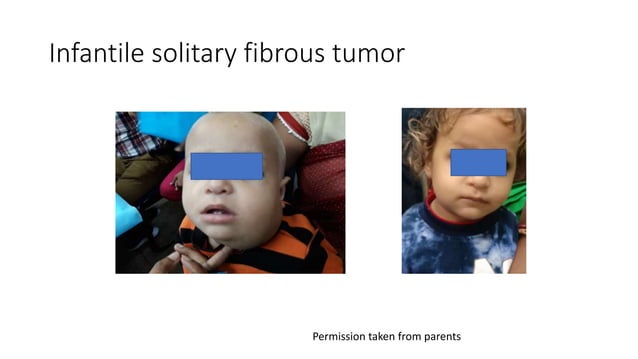 pediatric soft tissue sarcoma _ targeted therapy.pptx