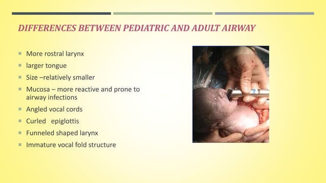 Pediatric stridor | PPTX