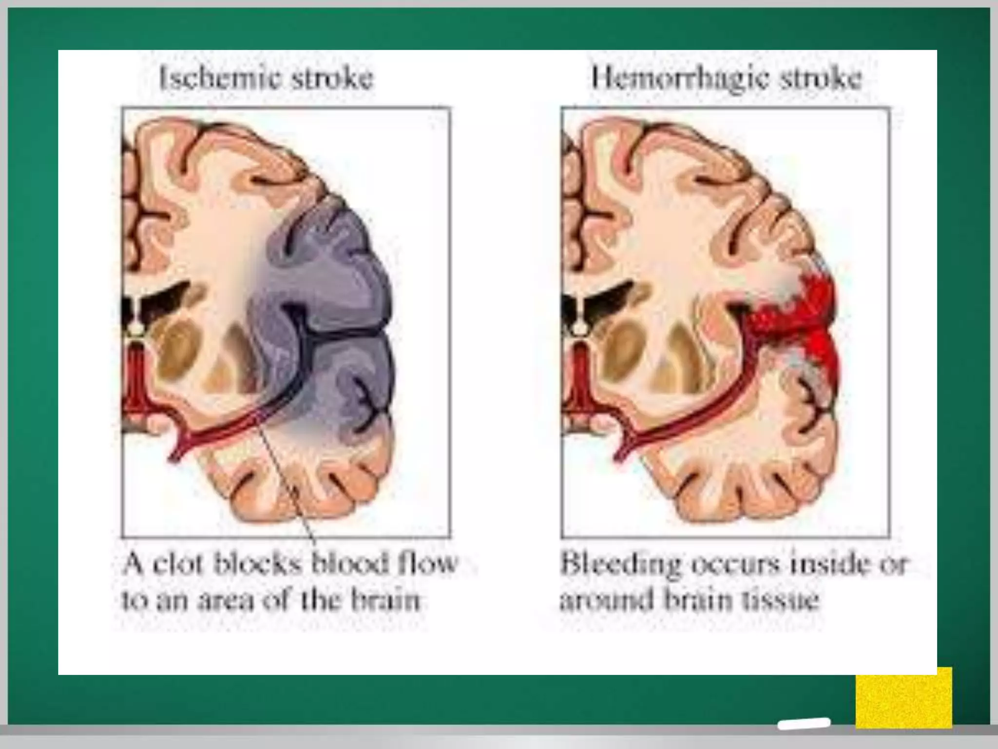 Pediatric Stroke | PPTX