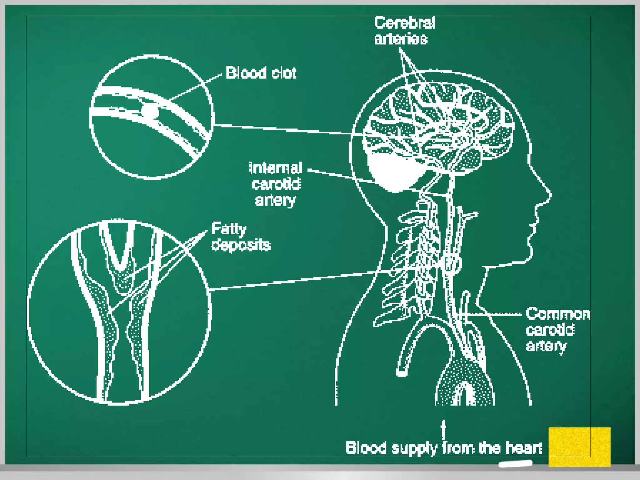 Pediatric Stroke | PPTX