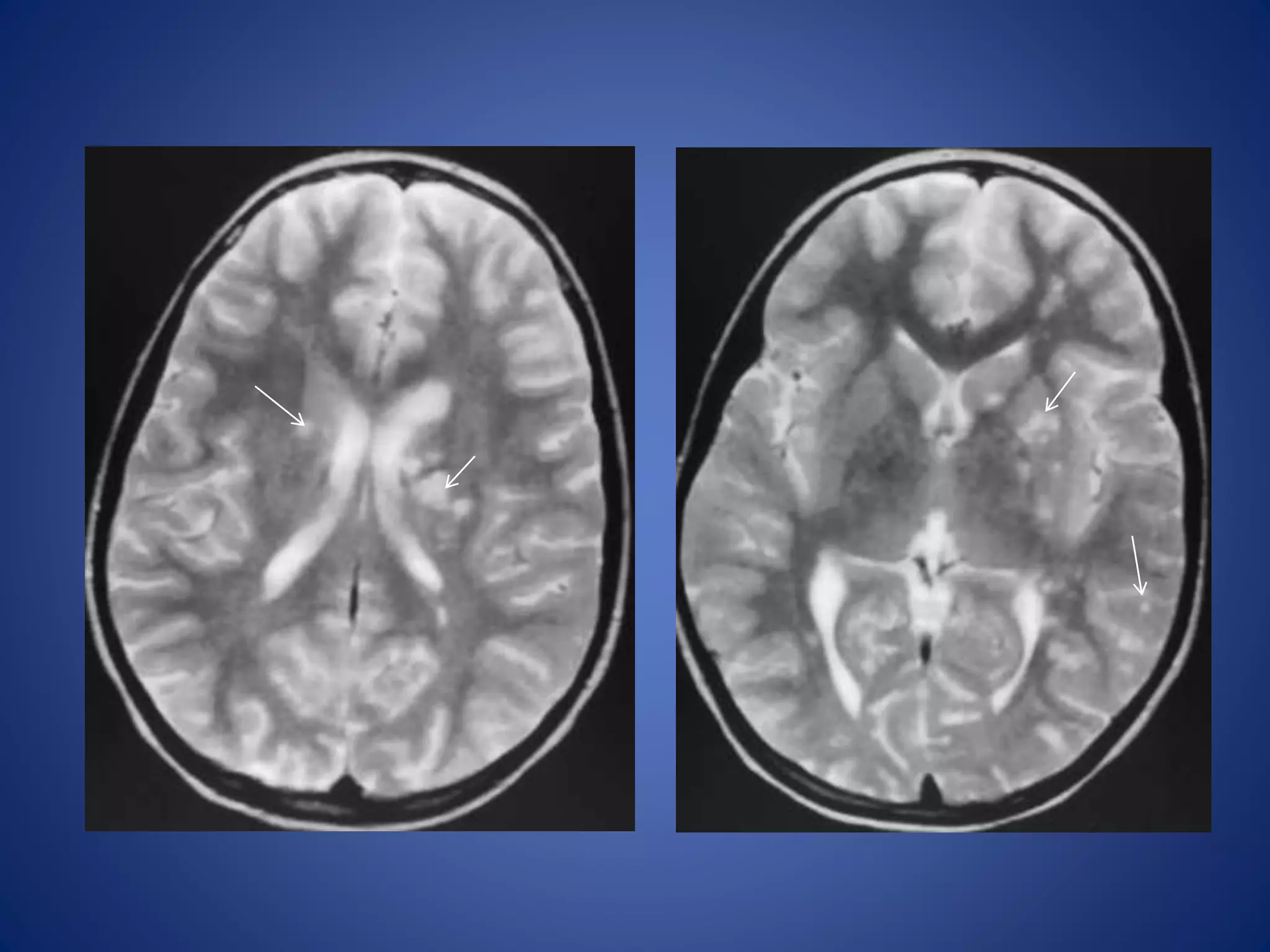 Pediatric stroke radiology | PPTX