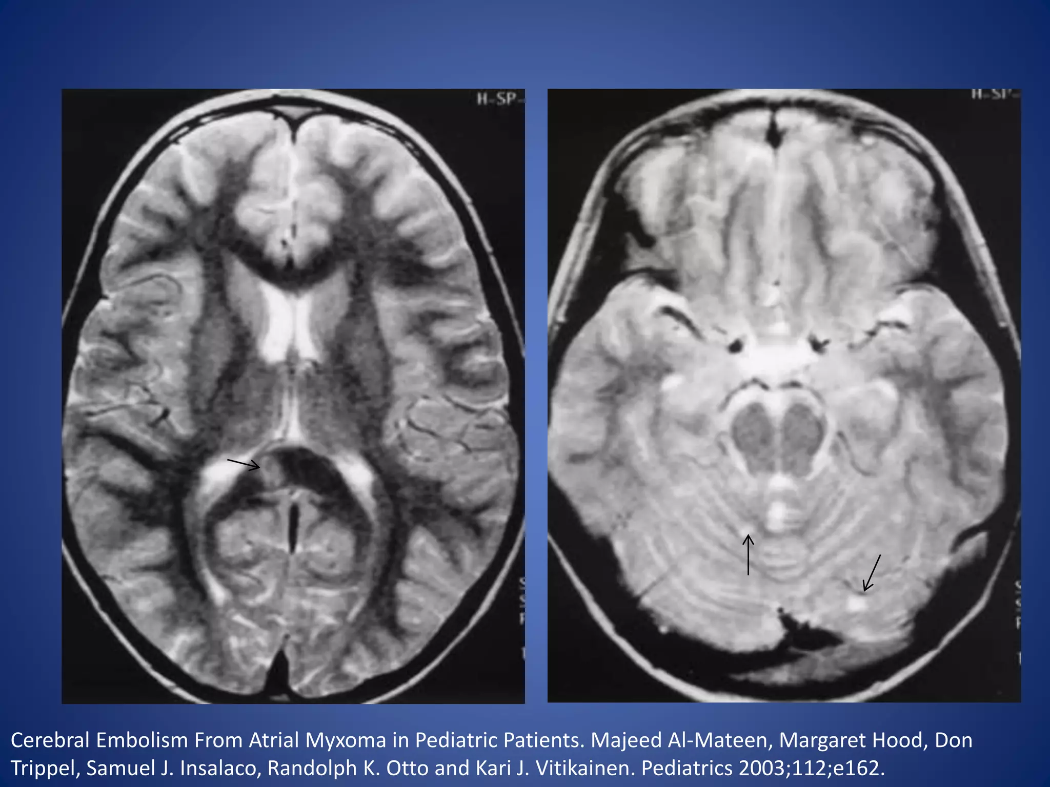 Pediatric stroke radiology | PPTX