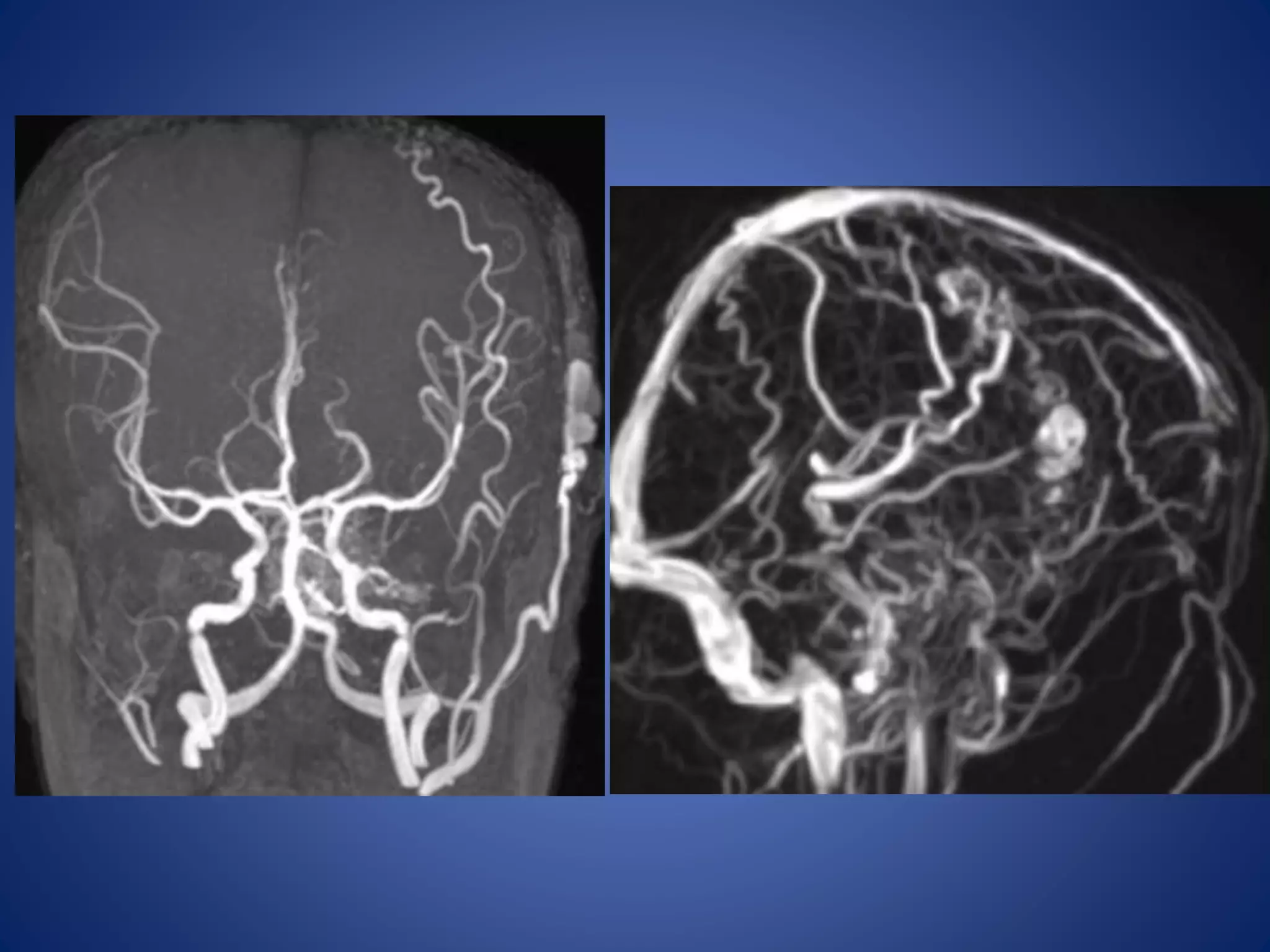Pediatric stroke radiology | PPTX