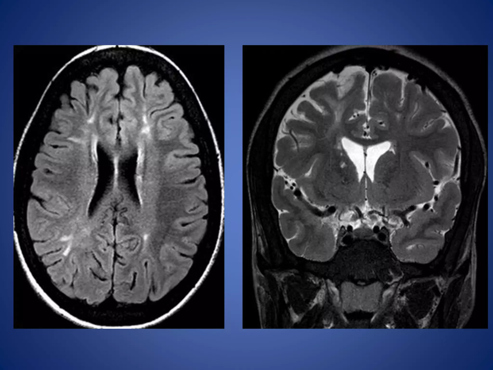 Pediatric stroke radiology | PPTX