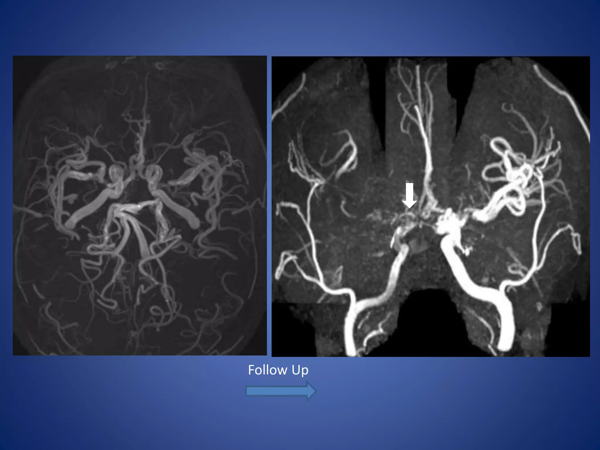 Pediatric stroke radiology | PPTX