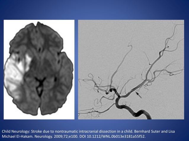 Pediatric stroke radiology | PPTX | Infectious Diseases | Diseases and ...