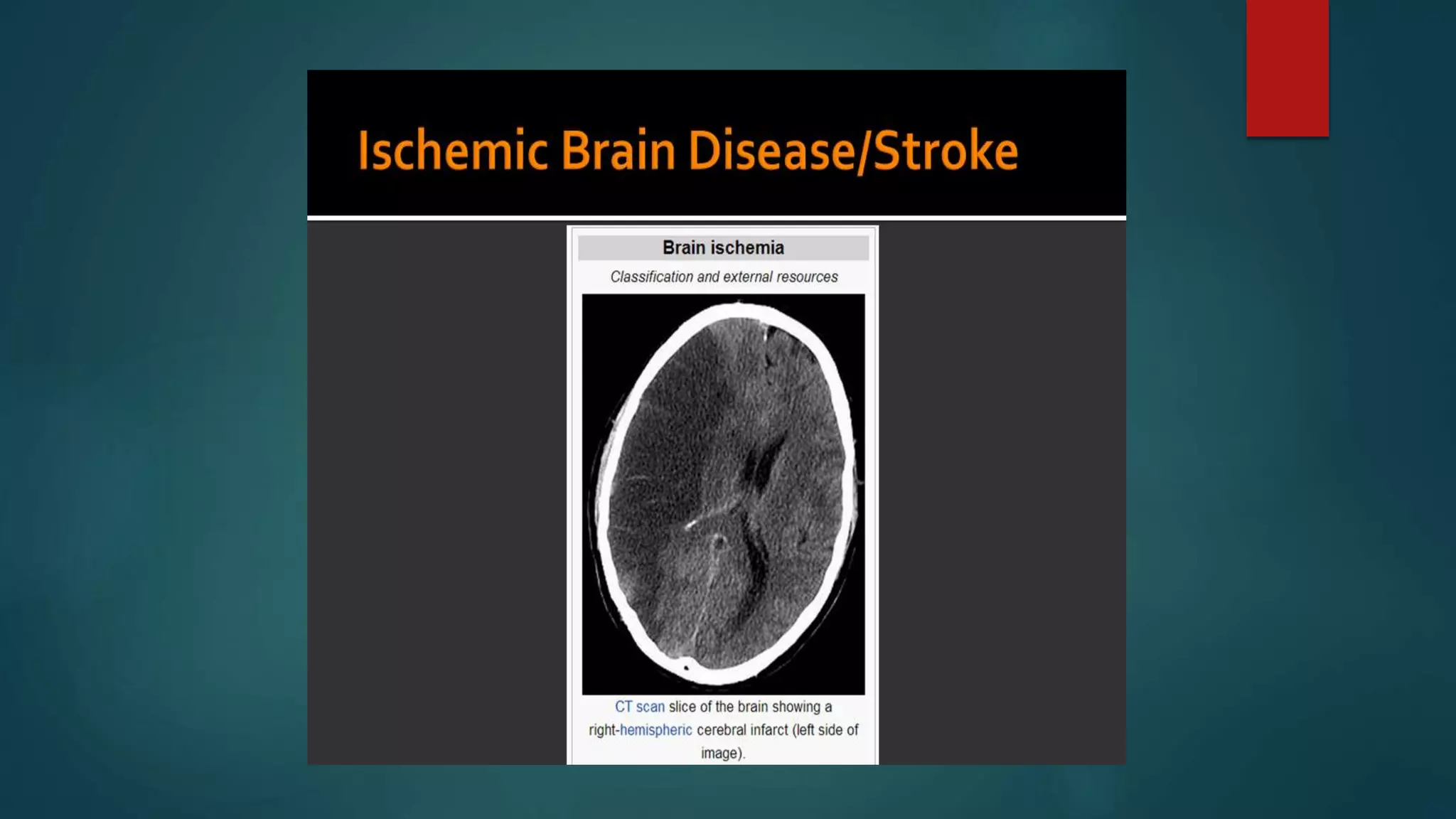 Pediatric stroke syndromes | PPTX