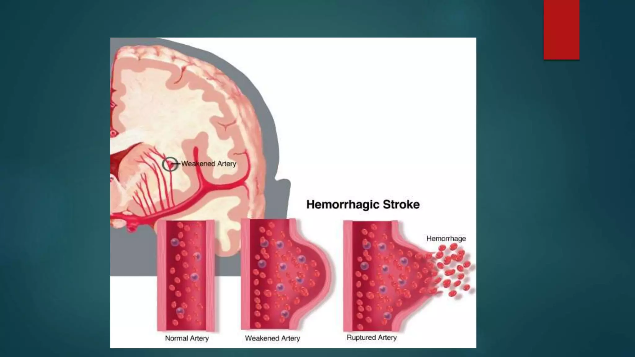 Pediatric stroke syndromes | PPTX