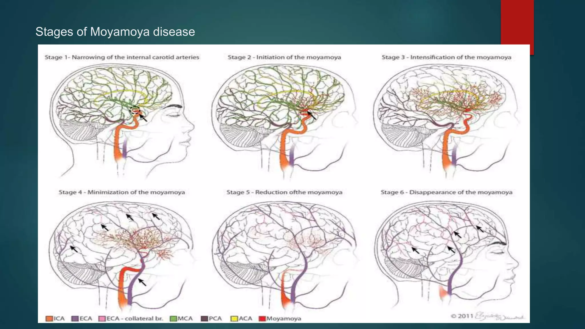 Pediatric stroke syndromes | PPTX