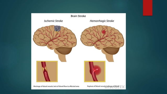 Pediatric stroke syndromes | PPT