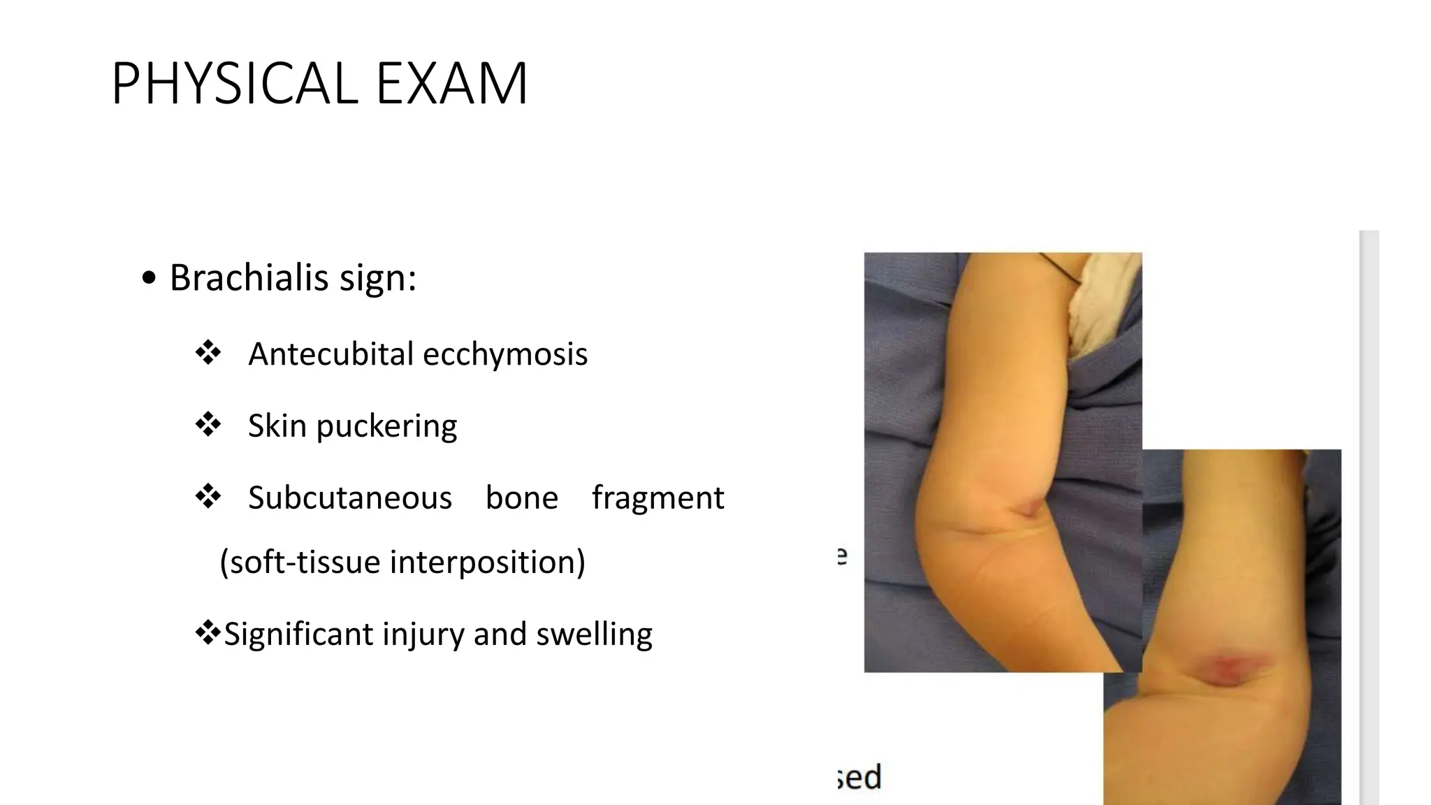 Pediatric supracondylar fjjractures.pptx