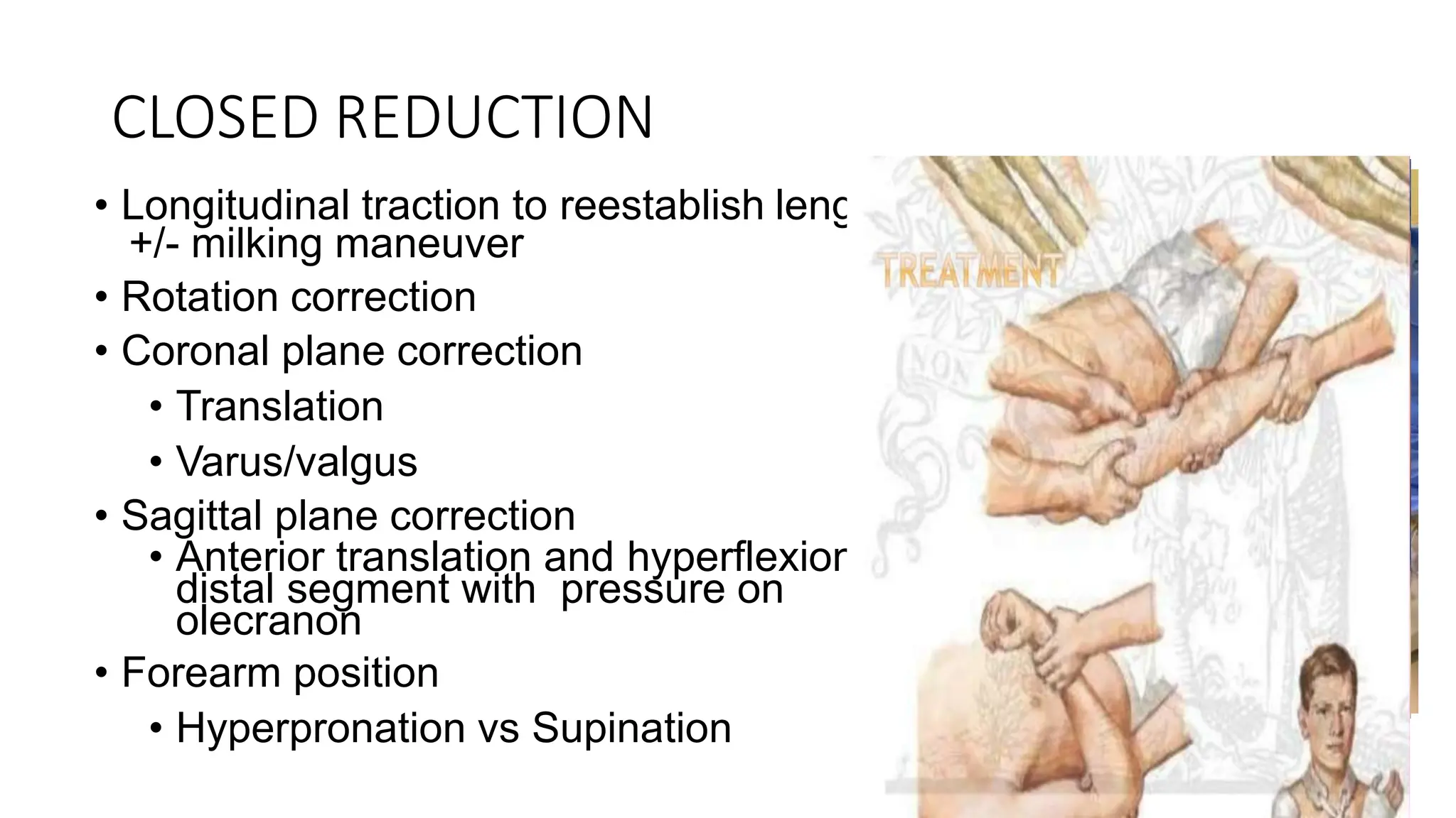 Pediatric supracondylar fjjractures.pptx