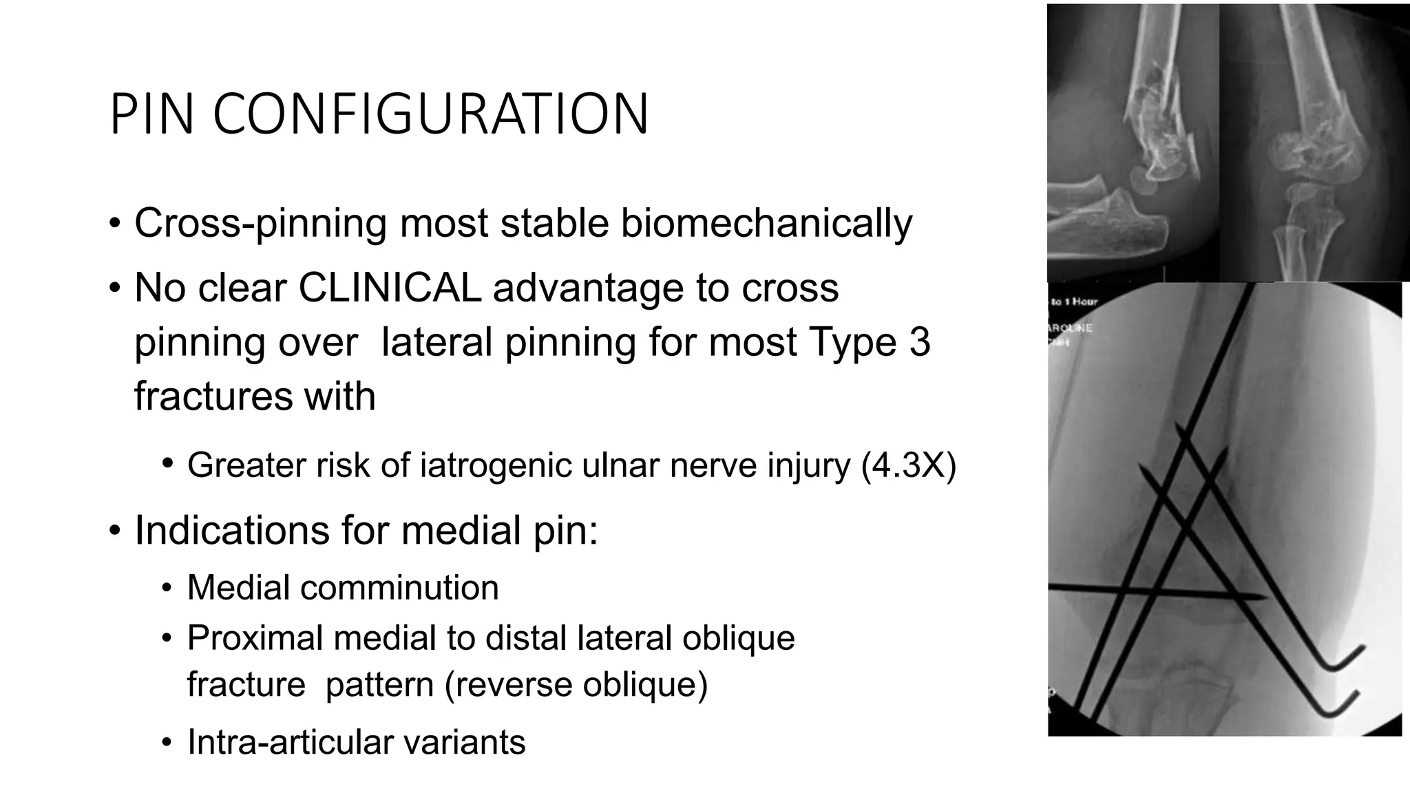 Pediatric supracondylar fjjractures.pptx