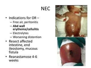Pediatric surgery ABSITE | PPTX