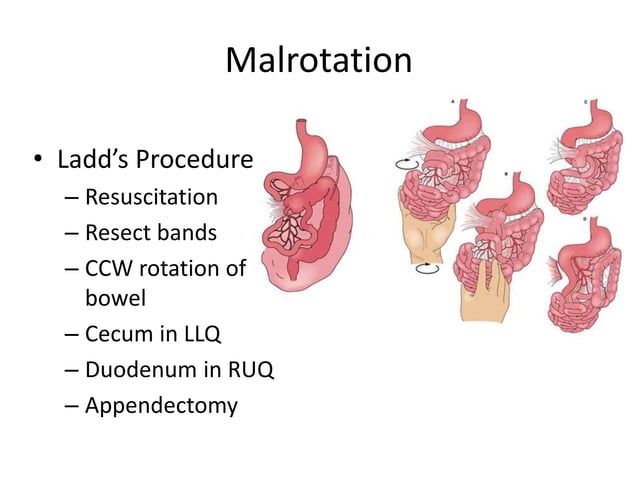 Pediatric surgery ABSITE | PPTX | Digestive Disorders | Diseases and ...