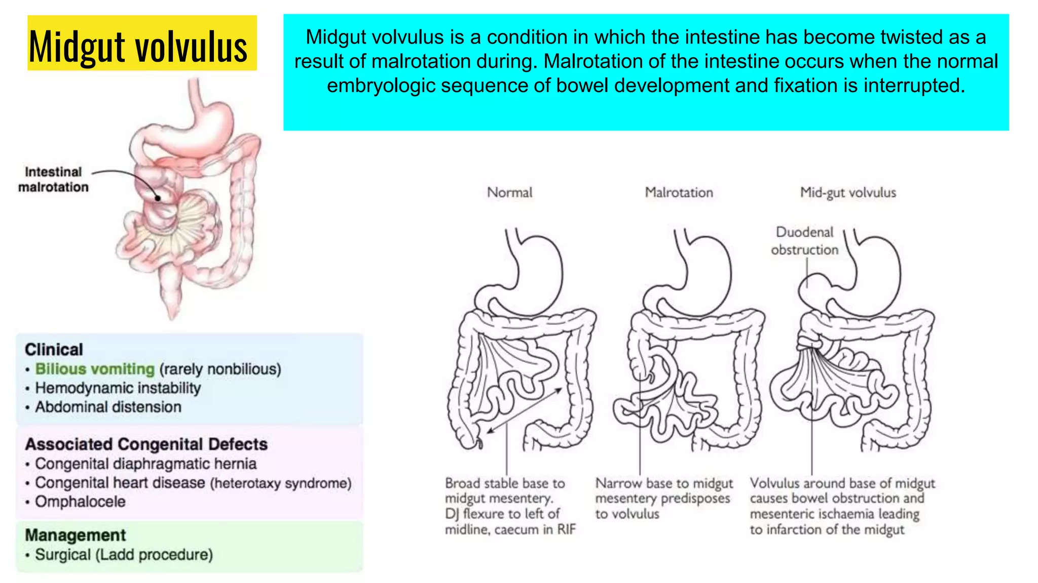 Pediatric surgery Gi abnormalities.pptx