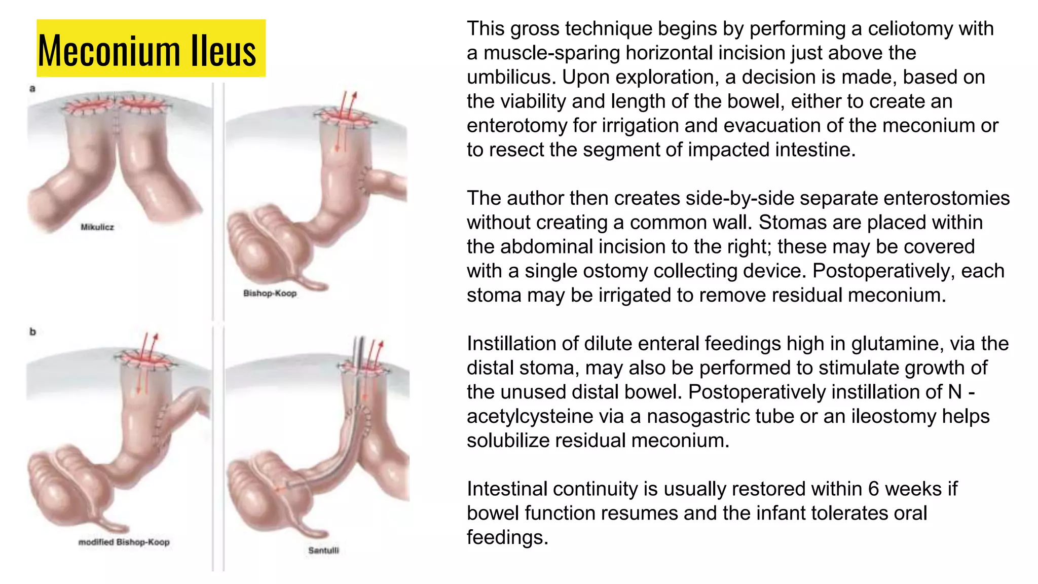 Pediatric surgery Gi abnormalities.pptx