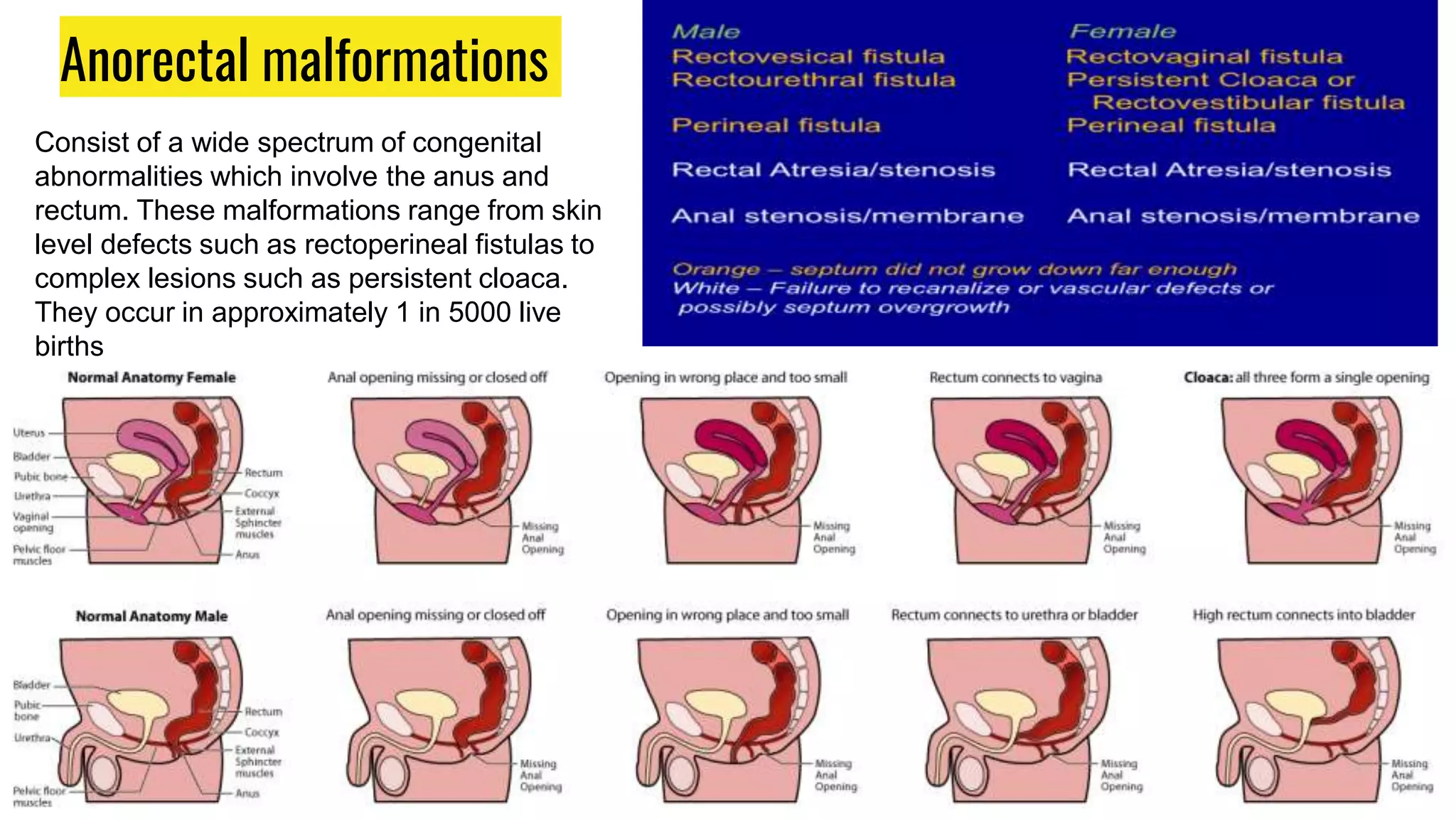 Pediatric surgery Gi abnormalities.pptx