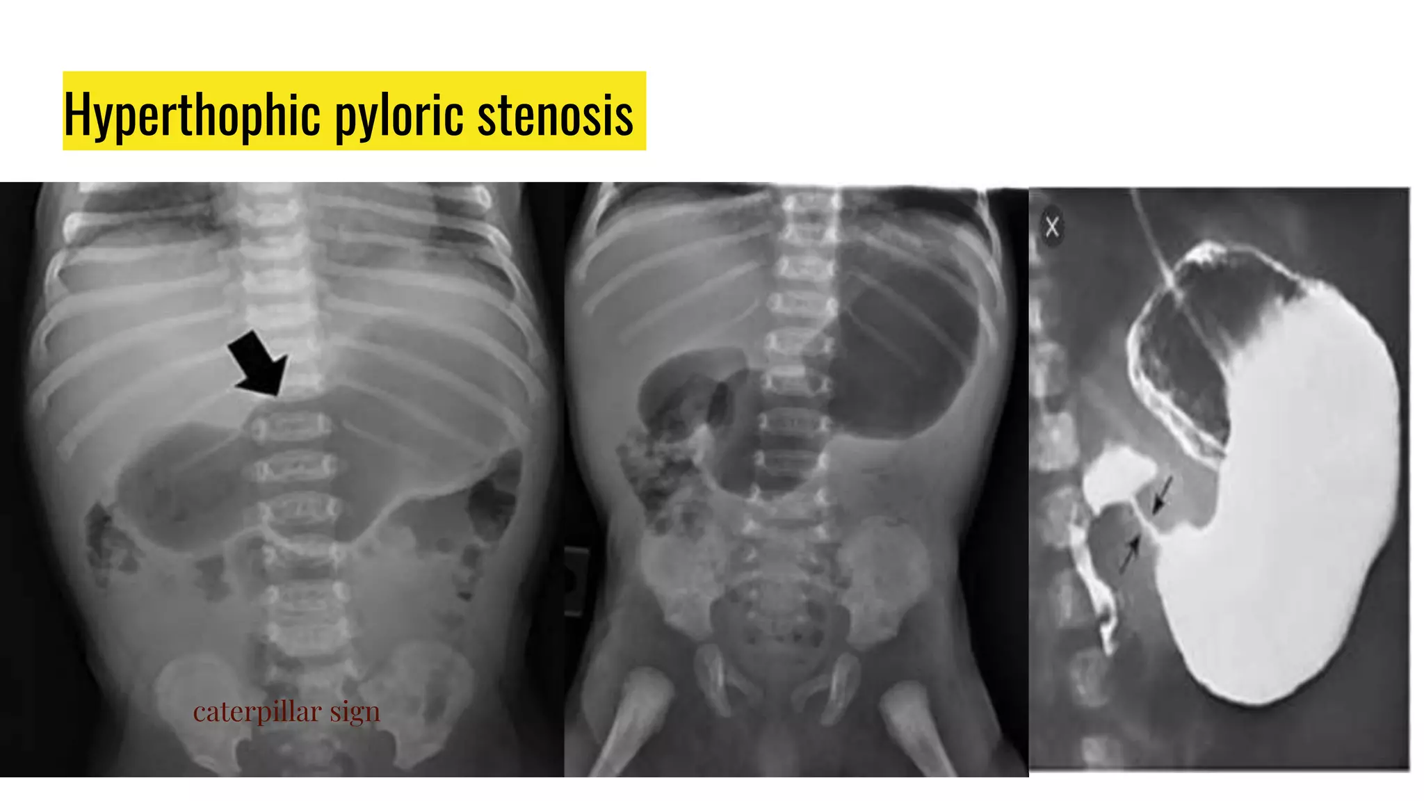 Pediatric surgery Gi abnormalities.pptx