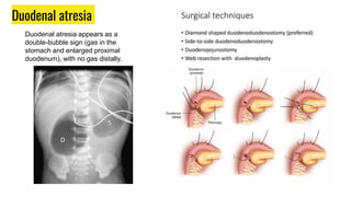 Pediatric surgery Gi abnormalities.pptx