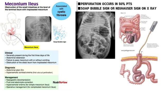 Pediatric surgery Gi abnormalities.pptx