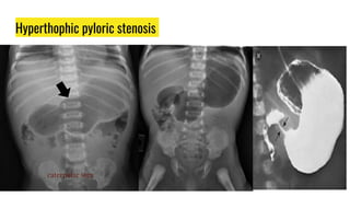Pediatric surgery Gi abnormalities.pptx