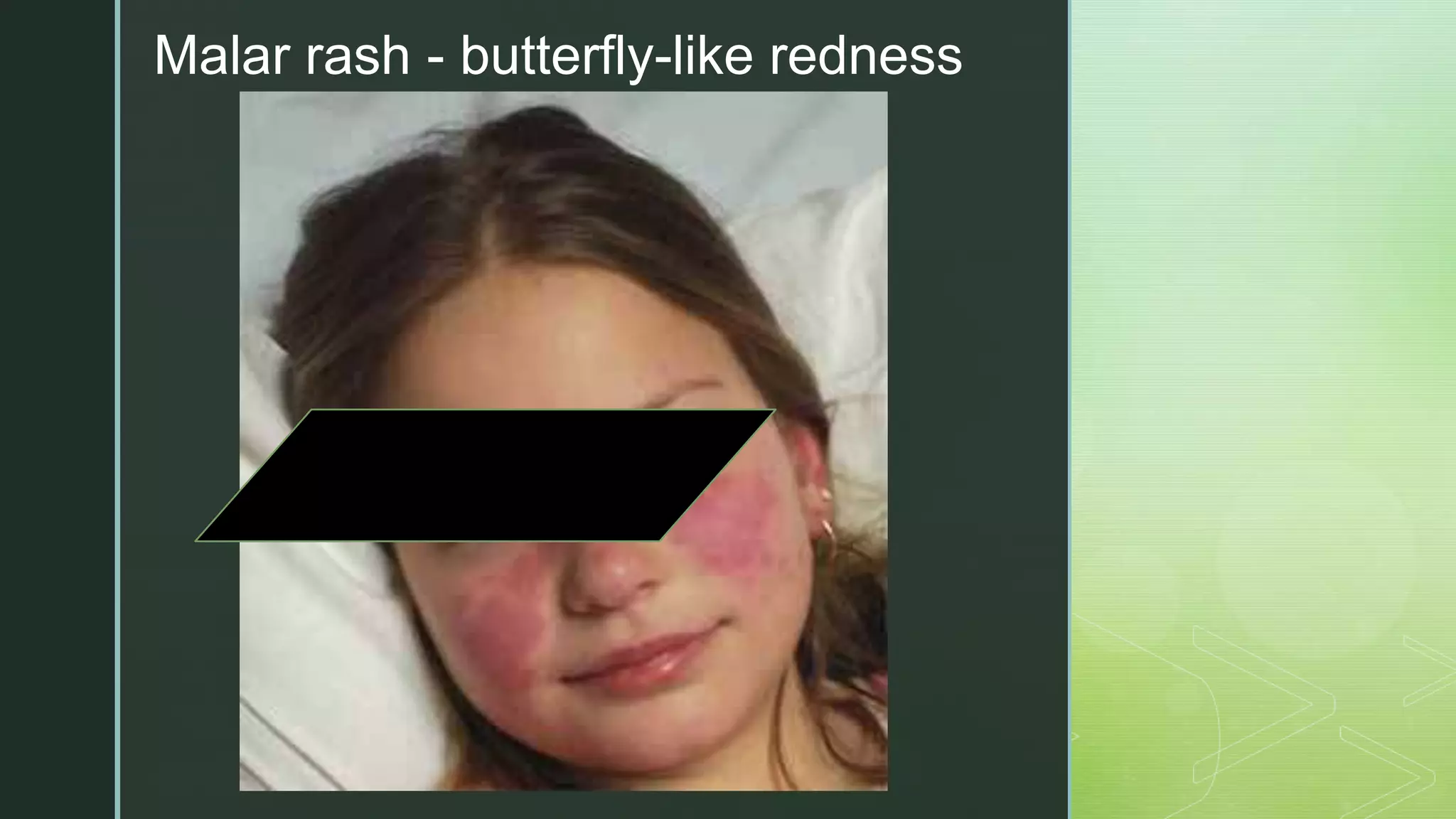 Pediatric systemic lupus erythematosus | PPTX