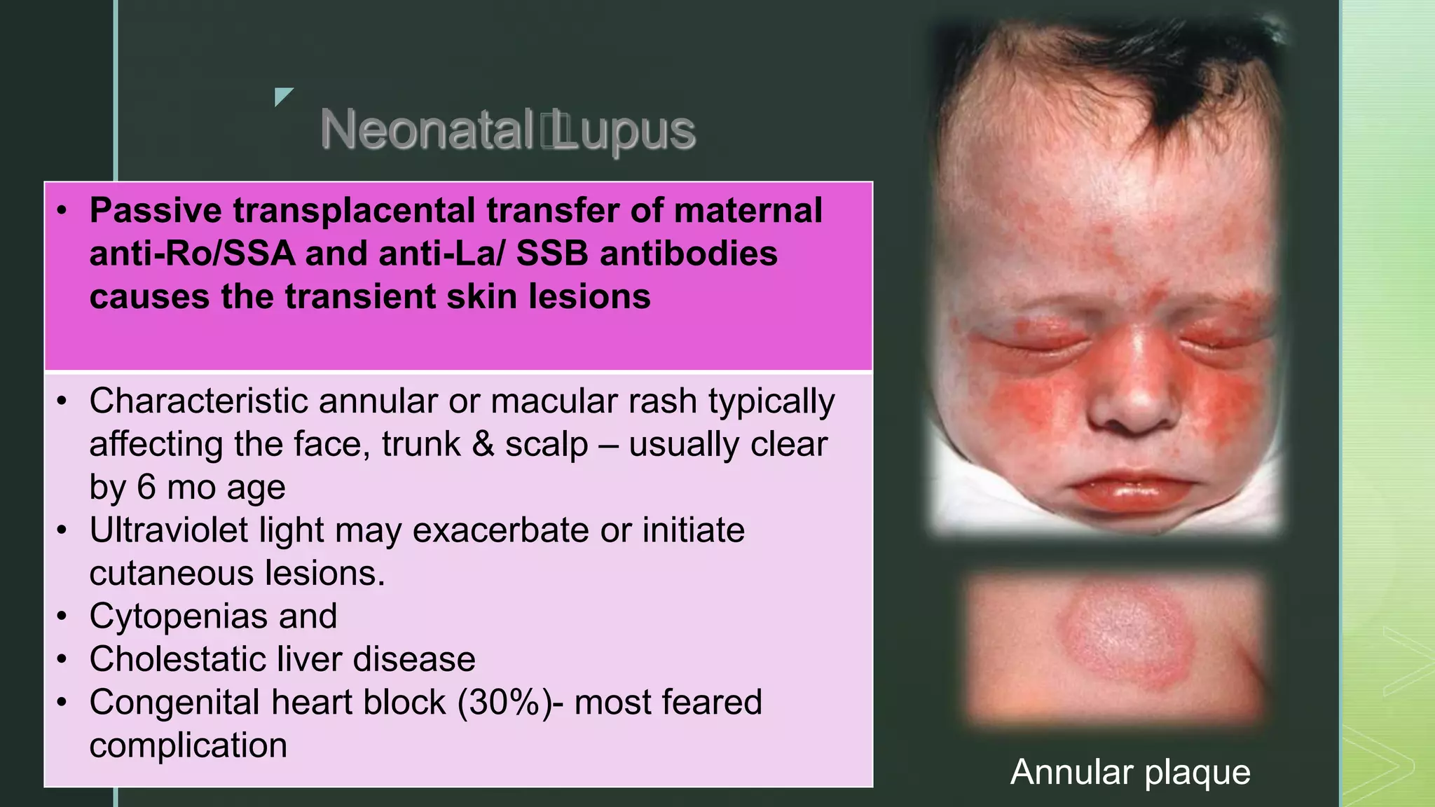 Pediatric systemic lupus erythematosus | PPTX