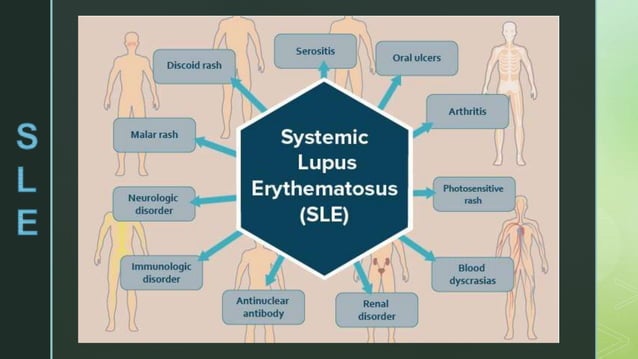 Pediatric systemic lupus erythematosus | PPT