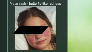 Pediatric systemic lupus erythematosus | PPTX | Blood Disorders ...