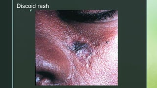 Pediatric systemic lupus erythematosus | PPTX