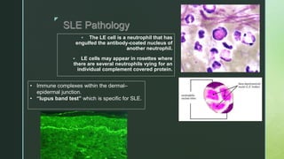Pediatric systemic lupus erythematosus | PPTX