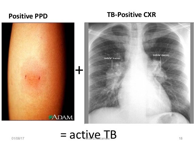 Managing Pediatric tuberculosis