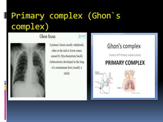 Pediatric tuberculosis dr. anu | PPT