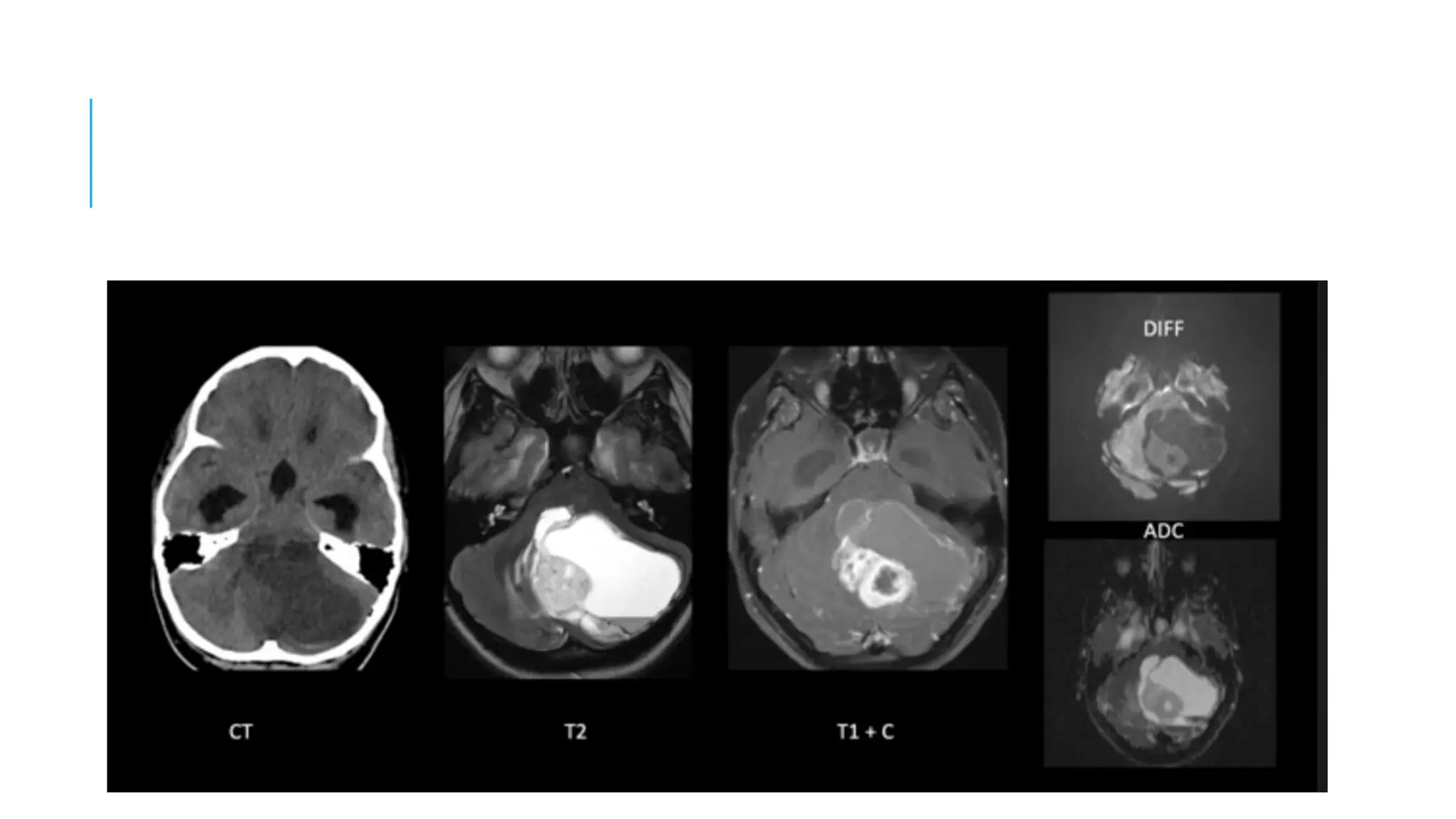 WHO CNS 5 2021 PEDIATRIC TUMOR CLASSIFICATION AND RADIOLOGY OF MOST ...