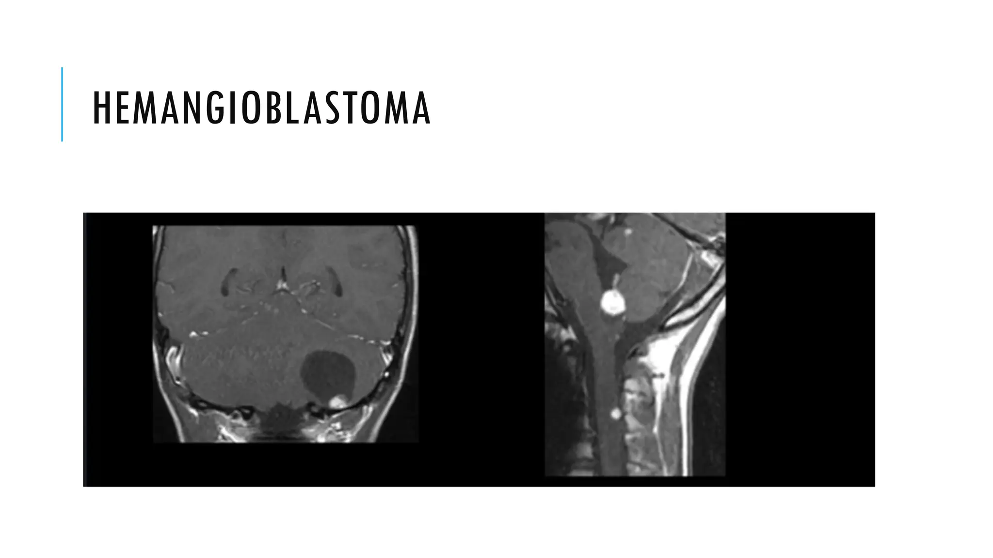 Who Cns 5 2021 Pediatric Tumor Classification And Radiology Of Most Common Pediatric Posterior