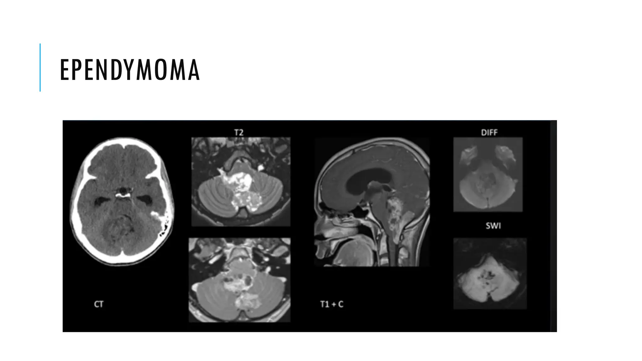 WHO CNS 5 2021 PEDIATRIC TUMOR CLASSIFICATION AND RADIOLOGY OF MOST ...