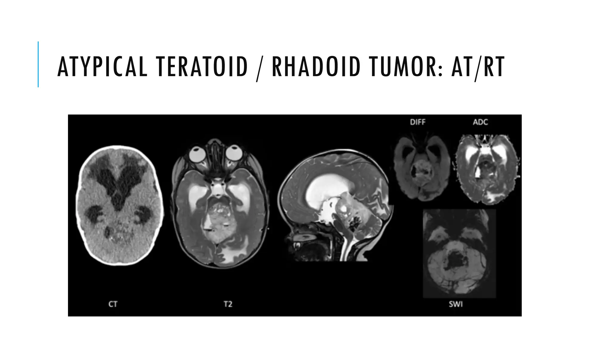Who Cns 5 2021 Pediatric Tumor Classification And Radiology Of Most Common Pediatric Posterior