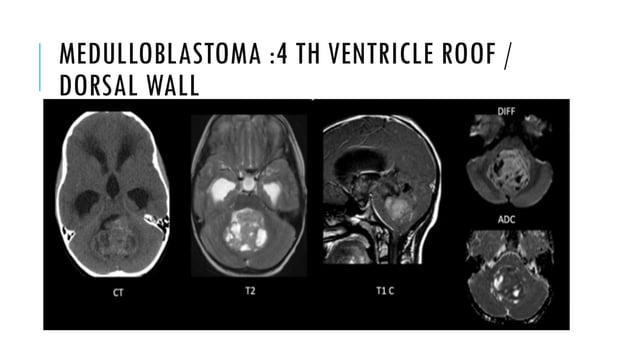 Who Cns 5 2021 Pediatric Tumor Classification And Radiology Of Most Common Pediatric Posterior