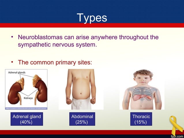 Common Pediatric Solid Tumors | PPT