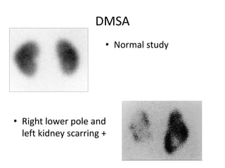 Pediatric urinary tract infection | PPTX