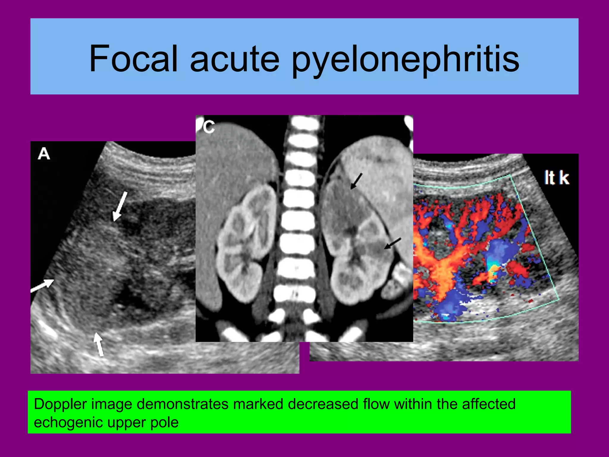Pediatric urinary tract infection..the role of imaging | PPT
