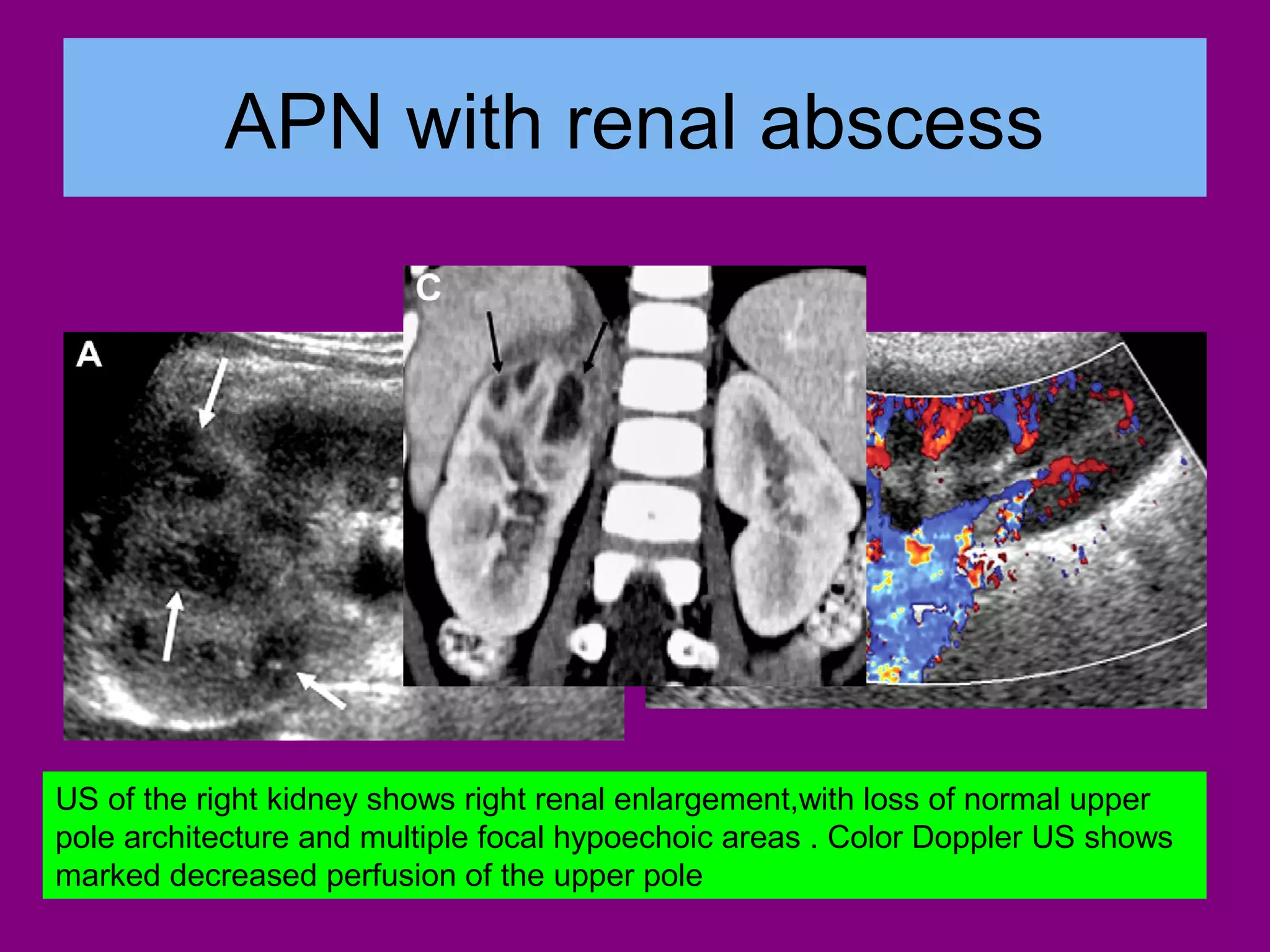 Pediatric urinary tract infection..the role of imaging | PDF