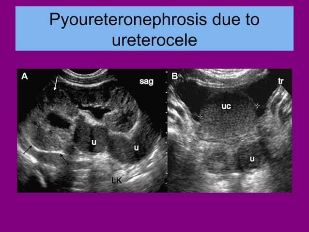 Pediatric urinary tract infection..the role of imaging | PPT