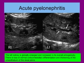 Pediatric urinary tract infection..the role of imaging | PDF